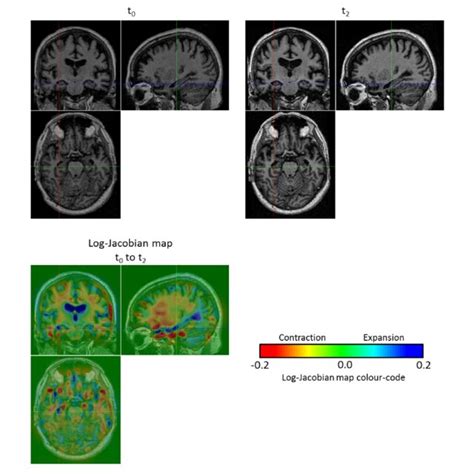 Log Jacobian Map For The Subject Oas20002 We Computed The Download Scientific Diagram