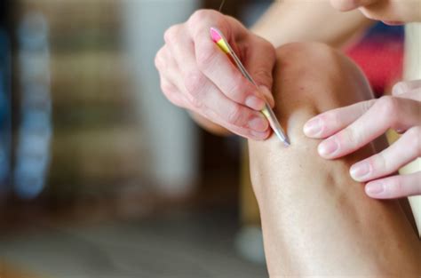 Ingrown Hair Cyst Common Causes And Home Treatment