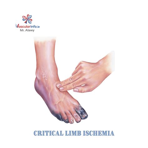 Peripheral Arterial Disease Vascular Info