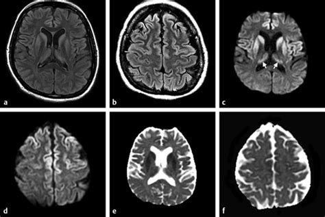 Diffusion Weighted And Diffusion Tensor Imaging In Infectious Diseases Radiology Key