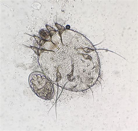 Scabies Under Microscope