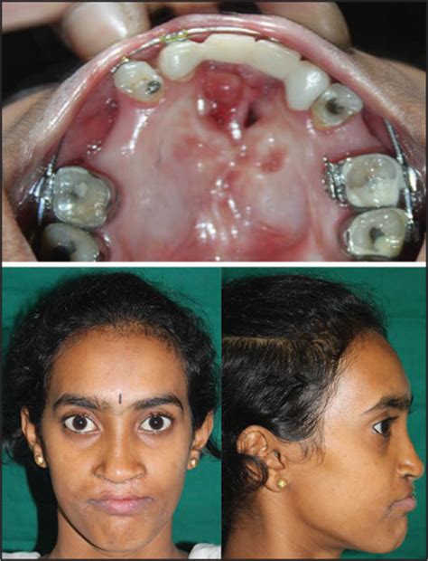 Treatment Of Severe Maxillary Cleft Hypoplasia In A Case With Missing
