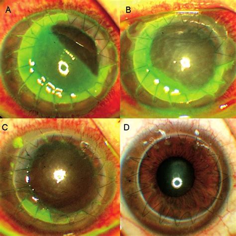 Fluorescein Staining Of The Epithelial Defect At 8 Days After Surgery
