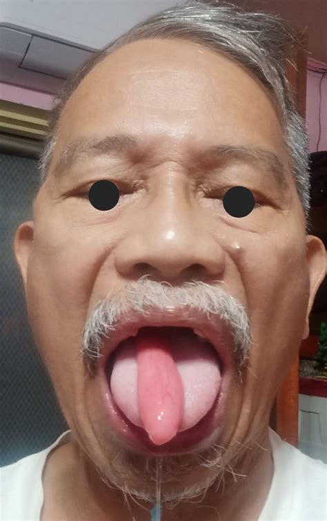 63‐year‐old Male With A Pedunculated Smooth Mass Protruding Outside The Download Scientific