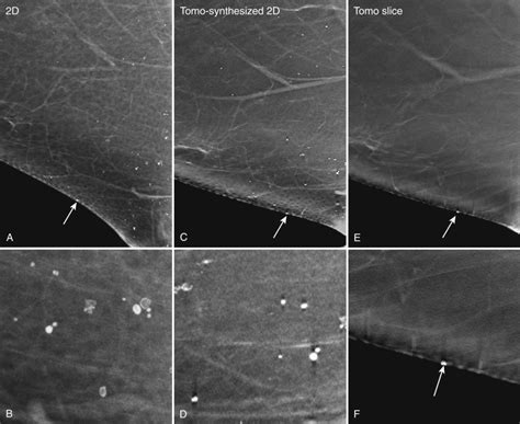Mammographic Analysis Of Breast Calcifications Clinical Tree