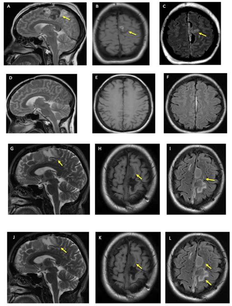A Patient With Erdheim Chester Disease Limited To Central Nervous System