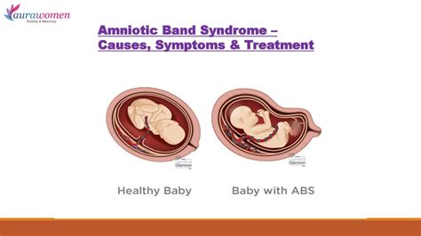 Amniotic Band Syndrome Abs Causes Symptoms And Treatment Aurawomen