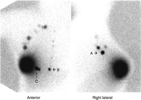 Lymphoscintigraphic Mapping In Melanoma And Breast Cancer Journal Of