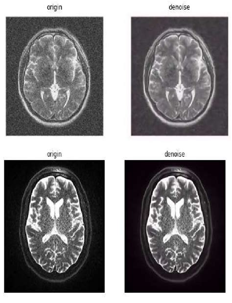 Table Ii From Image Reconstruction Method For Ultrafast Ultrasonic Imaging Based On