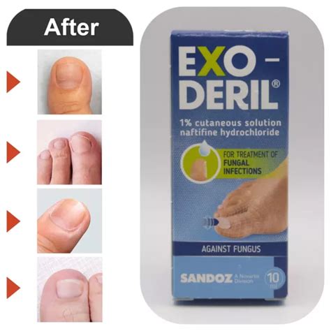 Exoderil 1 10ml Anti Fungal Nail Treatment Fungus Solution Finger Toe
