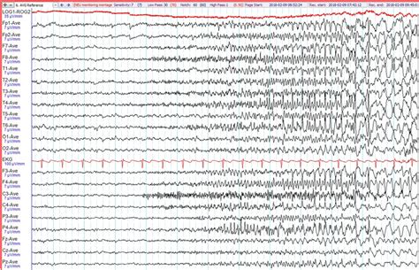 Ictal Eeg Reveals Background Attenuation Followed By Fast Rhythmic