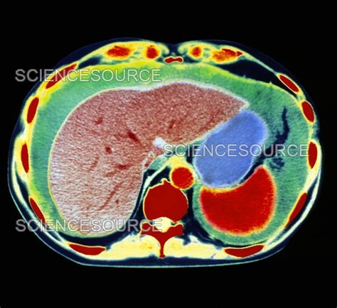 Coloured Ct Scan Showing Ascites Of Th Stock Image Science Source