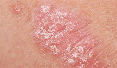 What Is Psoriasis PsoriasisSPEAKS