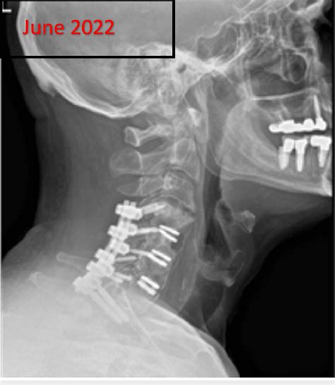 X Ray Post Operative Anterior Discectomy At C4 C5 C5 C6 And C6 C7 Download Scientific Diagram