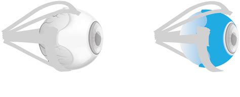 Enoftalmo Chirurgia Occhio Infossato Dott Oculista Dario Surace