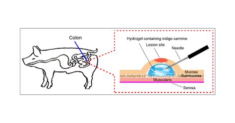 Safe And Efficient Colonic Endoscopic Submucosal Dissection Using An Injectable Hydrogel Acs