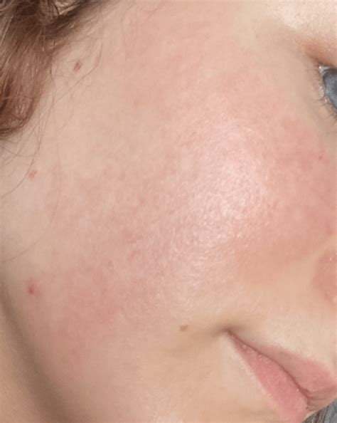 Ivermectin Rrosacea