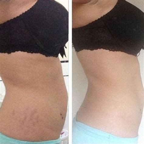 Weight Loss Stretch Marks Pinoyvirt