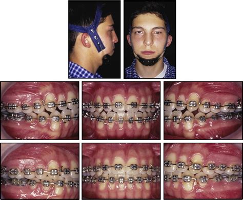 Eight Year Stability Of A Severe Skeletal Anterior Open Bite With A