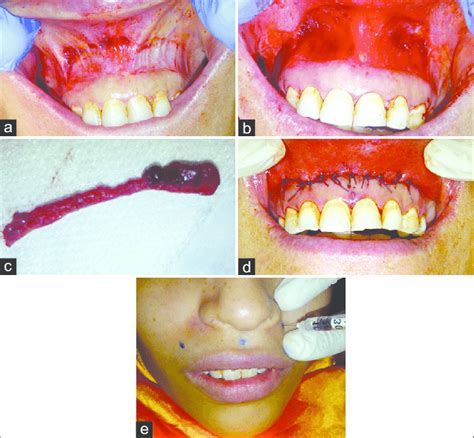 A The First Incision Was Made At The Mucogingival Junction B Download Scientific Diagram