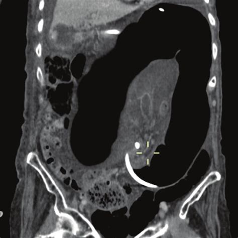 Synchronous Volvulus Of The Cecum And Sigmoid Colon Download Scientific Diagram