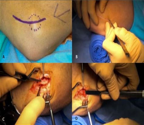 A D Operative Steps Of Open Surgery Surface Marking Skin Incision Download Scientific
