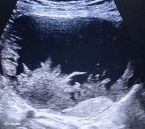 Mueni Mirriam On Linkedin Ovarian Cysts Insights From A Recent Case