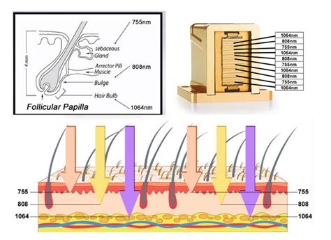 Vertical Triple Wavelength Diode Laser Hair Removal Systemsano Laser