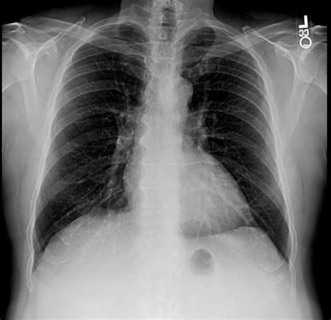 Diffuse Idiopathic Skeletal Hyperostosis Wikidoc