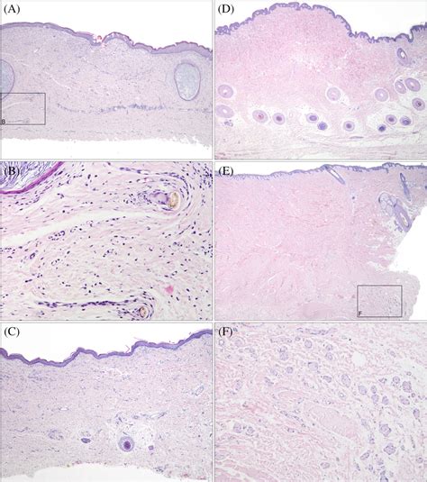 Aplasia Cutis Congenita Of The Scalp Histopathologic Features And