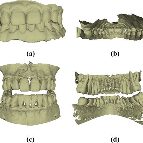 Intraoral Scanning Dental 3d Model And Cbct Dental 3d Model A 3d Model Download Scientific