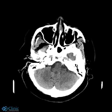 Eclinic Hub On Linkedin Luxury Perfusion Also Known As Post Ischemic