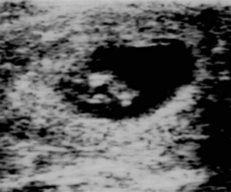 Fa Pregnancy Diagnosis Flashcards Quizlet