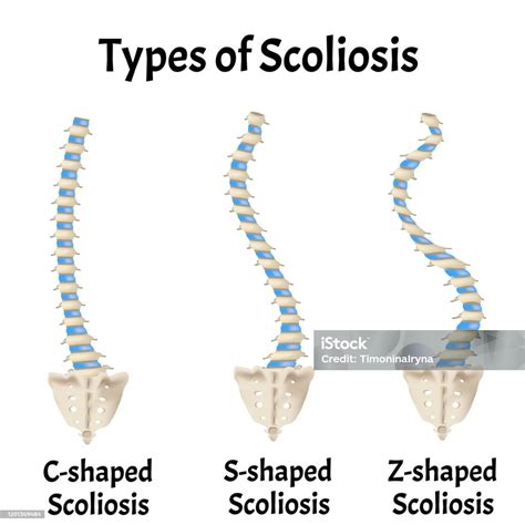 Ilustración De Tipos De Escoliosis Escoliosis En Forma De C S Z