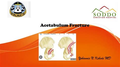 Acetabulum Fracture Treatment And Classification Pptx Acetabulum Fracture Treatment And Classification Pptx