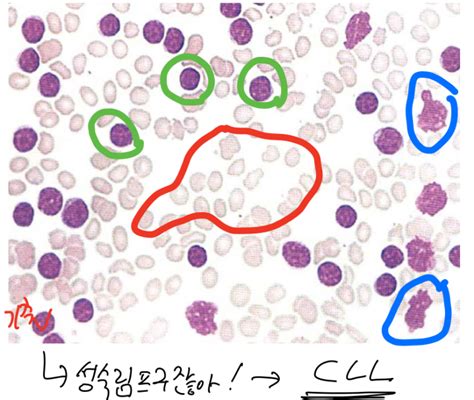 혈액 도말 사진 분석 지식in