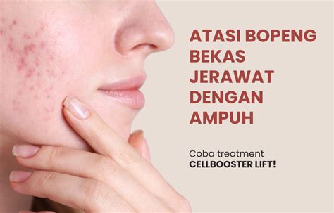 10 Cara Mengatasi Muka Bopeng Bekas Jerawat Yang Efektif St Indonesia