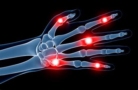 Early And Sustained Enthesitis Resolution With Secukinumab In Psoriatic