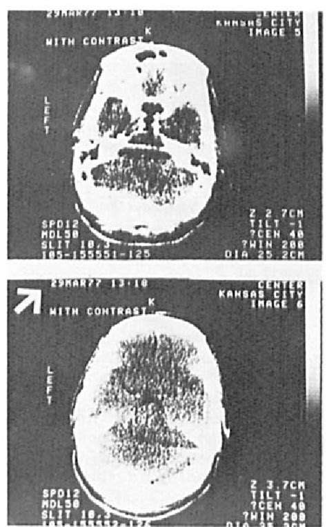 Figure 1 From The Ct Scan Pitfalls And Posterior Fossa Cisternography Semantic Scholar