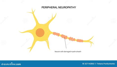 Peripheral Neuropathy Medical Poster Vector Illustration 324958338