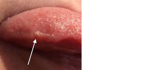 Lingual Papillitis