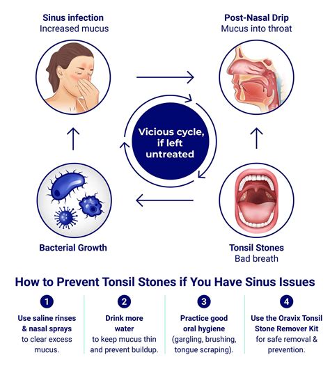 Post Nasal Drip And Tonsil Stones Whats The Link