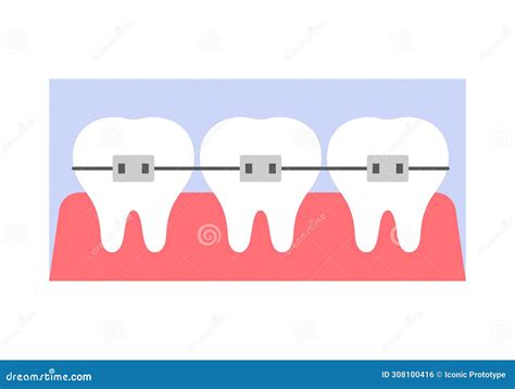 Dental Metal Braces For Straightening Teeth Diagram Structure Of Gum Vector Illustration