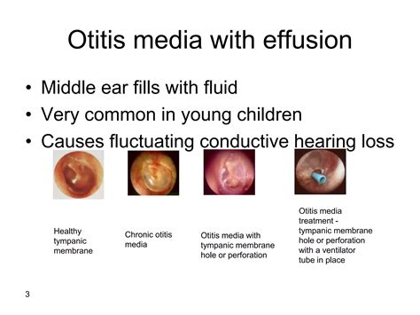 Otitis Media With Effusion An Illustration Of Ascertainment Bias Ppt