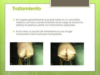 Estenosis Del Meato Uretral Pptx