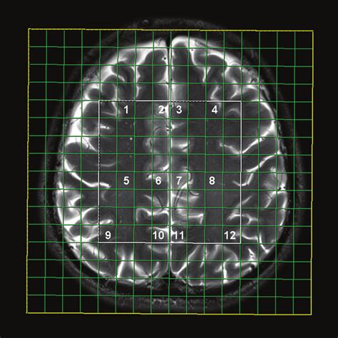 Multivoxel Mr Spectroscopy Voxel Network With Labeled Observed