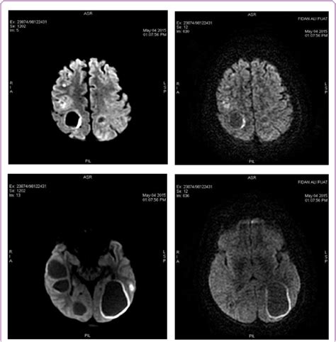 On Dwi Sequences Lesions Demonstrated Peripheral Restricted Diffusion Download Scientific