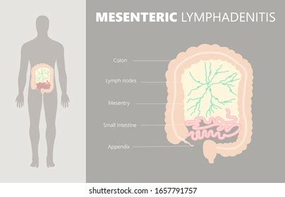 What Is Mesenteric Lymph Nodes