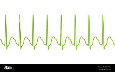 illustration depicting an atrial flutter abnormal heart rhythm on an