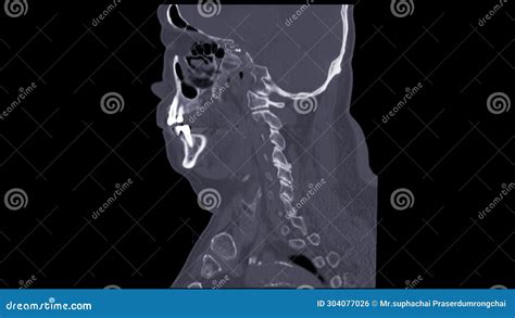 A Ct Scan Of The Neck Sagittal View For Diagnostic Technique Is Essential For Evaluating